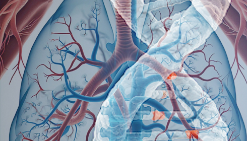 New Hope, New Questions: Can Datroway Redefine Lung Cancer Care?