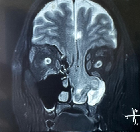 Atorvastatin with Ezetimibe- Drug Interactions, Dosage, Side Effects ...