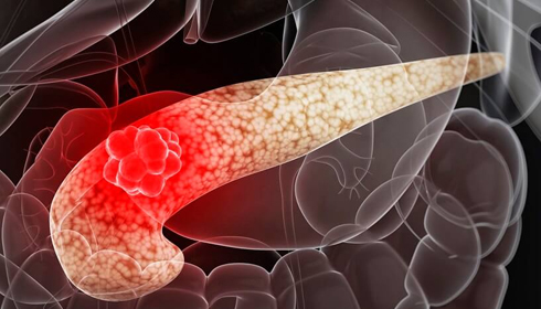 Cracking the Code of the ‘Silent Killer’: New Blood Test Fills the Gaps ...